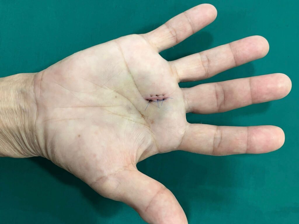 Trigger Finger Surgery Exercises Understanding Trigger Finger